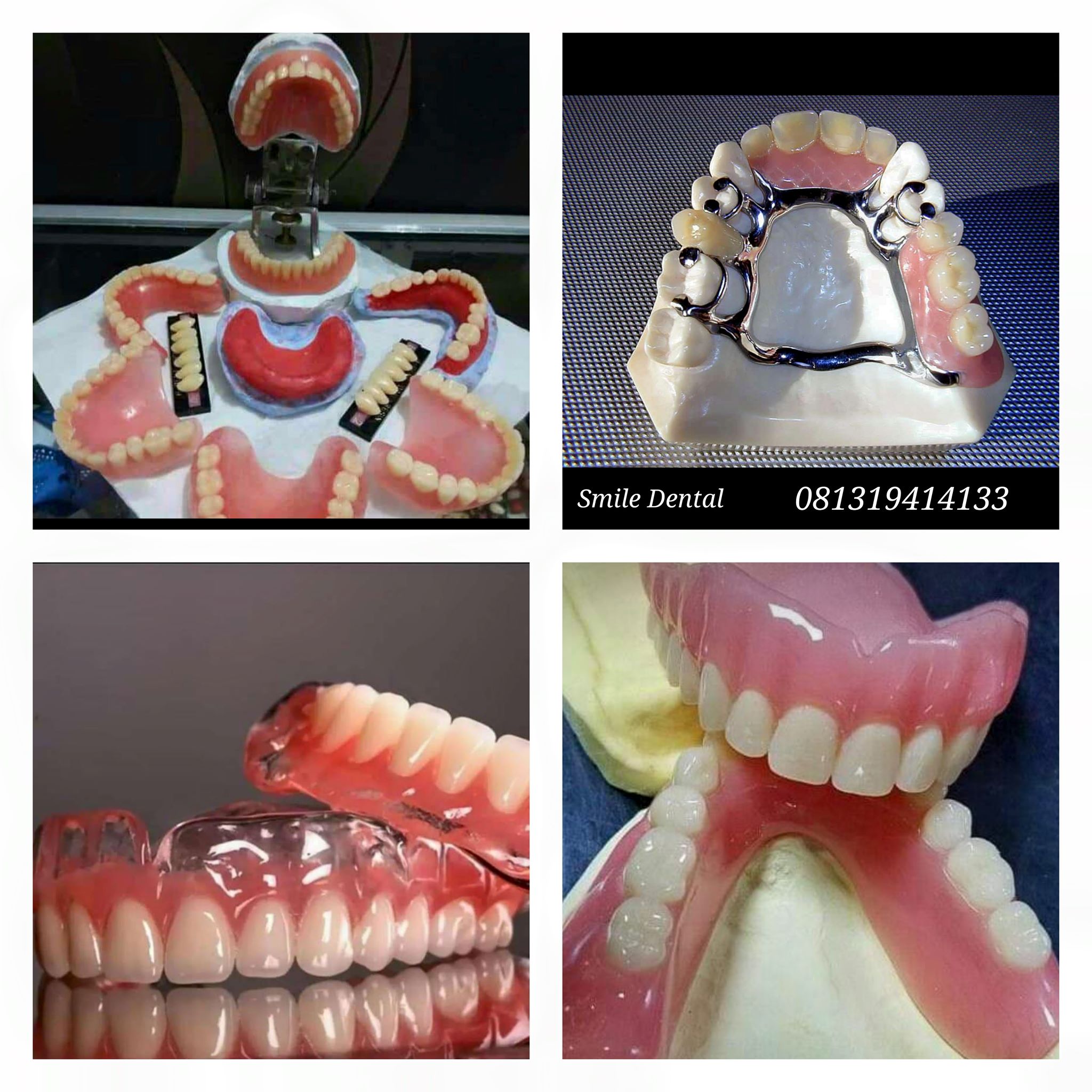 gigi palsu valplast Arsip - "SMILE DENTAL" AHLI GIGI PALSU"SMILE DENTAL ...